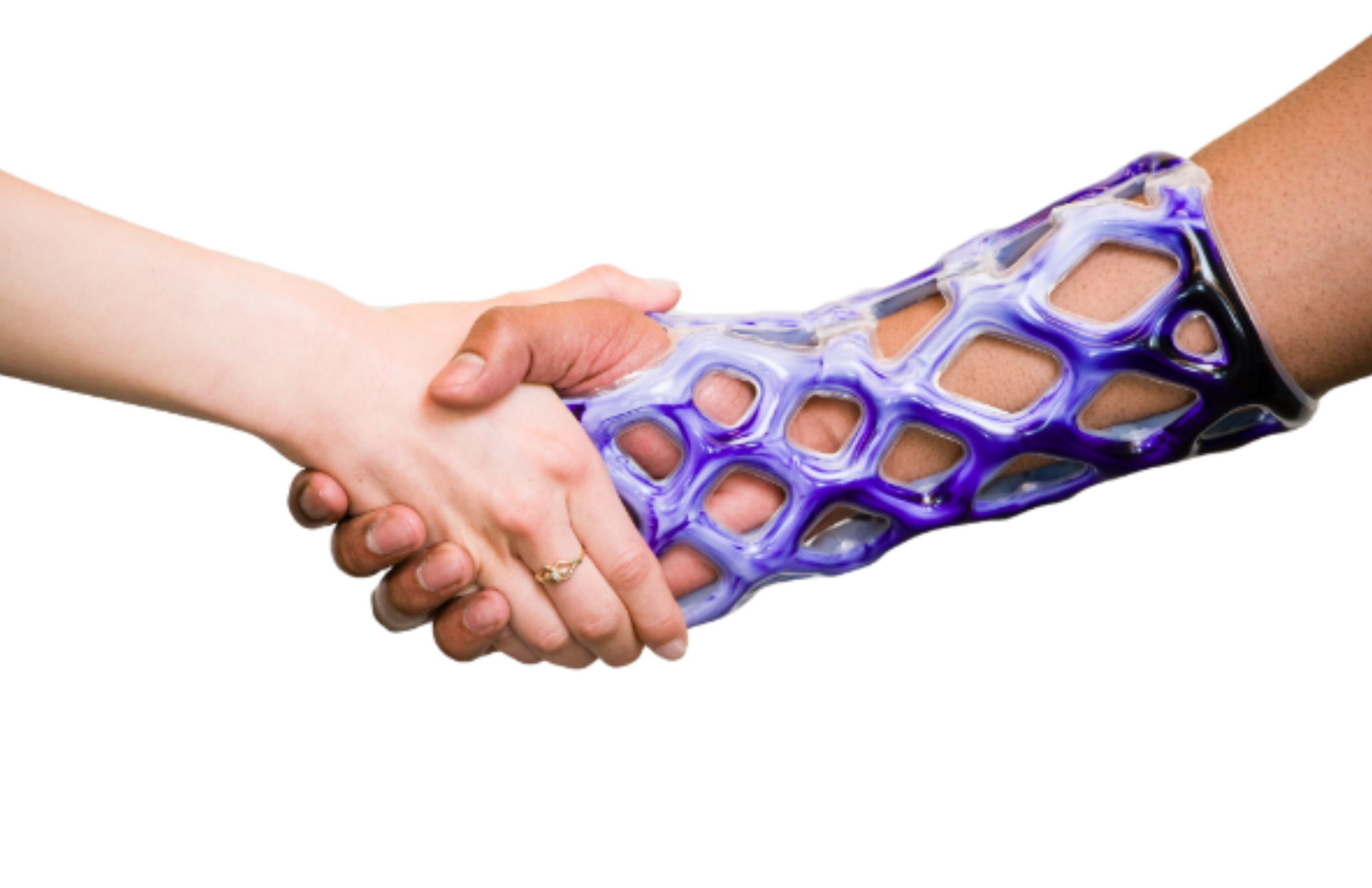 Cast21: The Revolutionary Technology for Treating Broken Bones