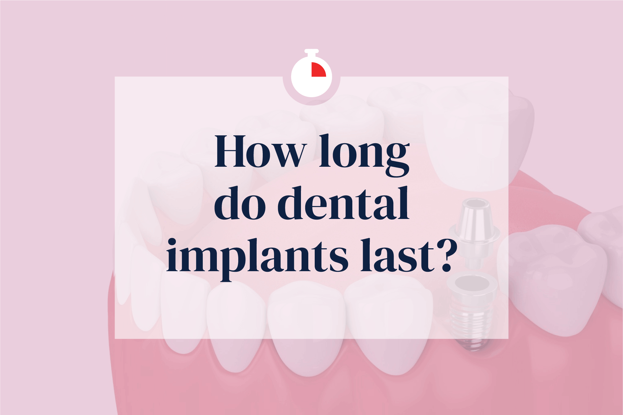 Trident Smiles Dental How Long Do Dental Implants Last 