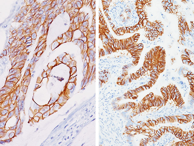 Comprender los cromógenos Vs. colorantes en inmunohistoquímica