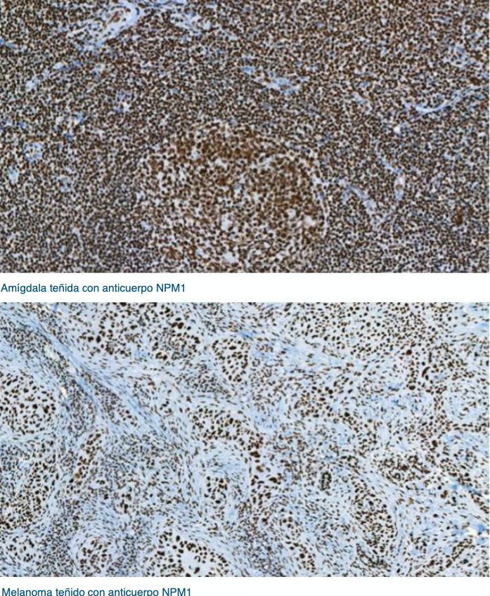 Conoce al marcador: NPM1