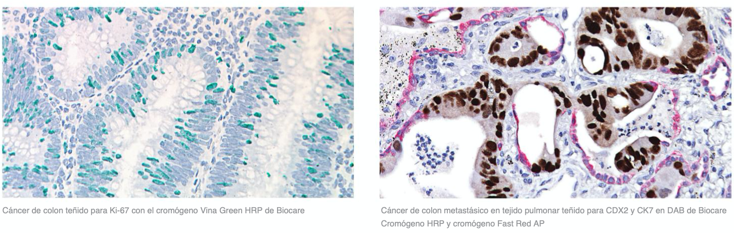 Comprender los cromógenos Vs. colorantes en inmunohistoquímica