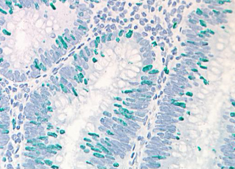 Comprender los cromógenos Vs. colorantes en inmunohistoquímica
