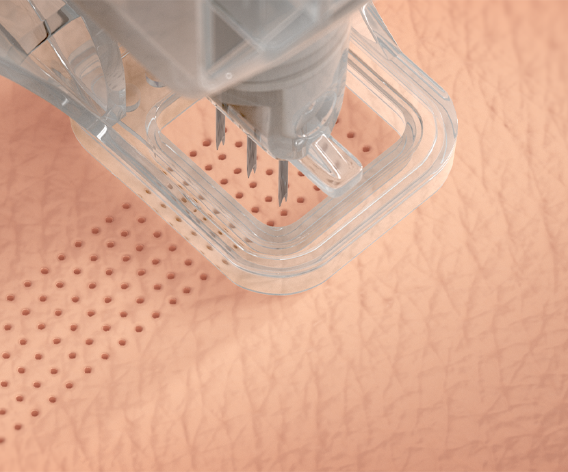 ellacor® Micro-Coring™ | Skincredible Dermatology & Surgery