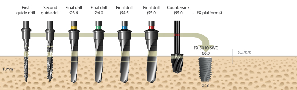 SuperLine Implants