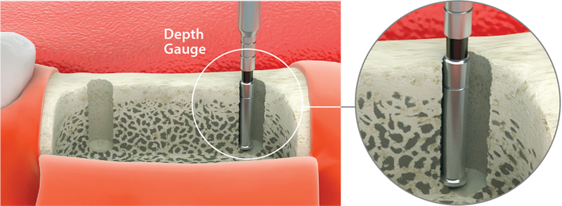 NR Line Implants