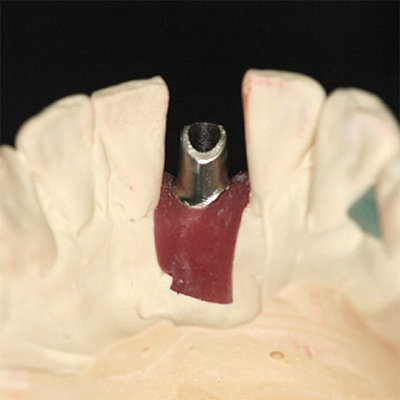 Dentium USA Custom Abutment