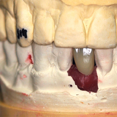 Dentium USA Custom Abutment