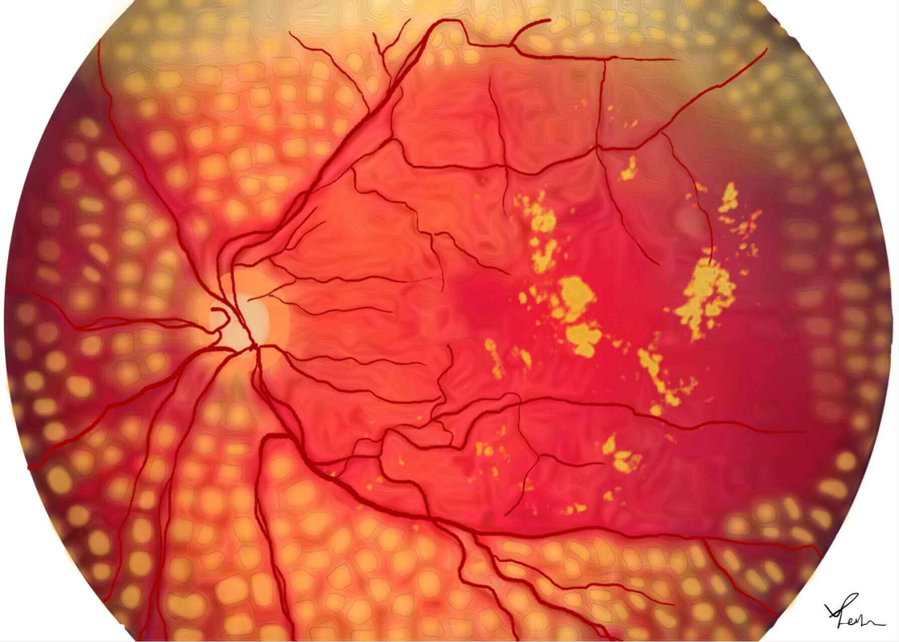 Pterygium