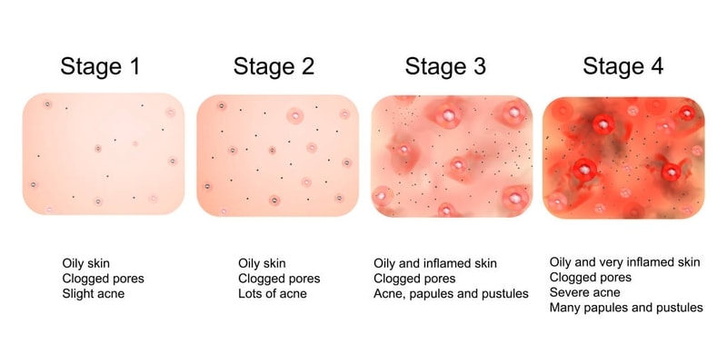 Acne Treatment Knoxville | Breakout Treatment Alcoa & Loudon, TN