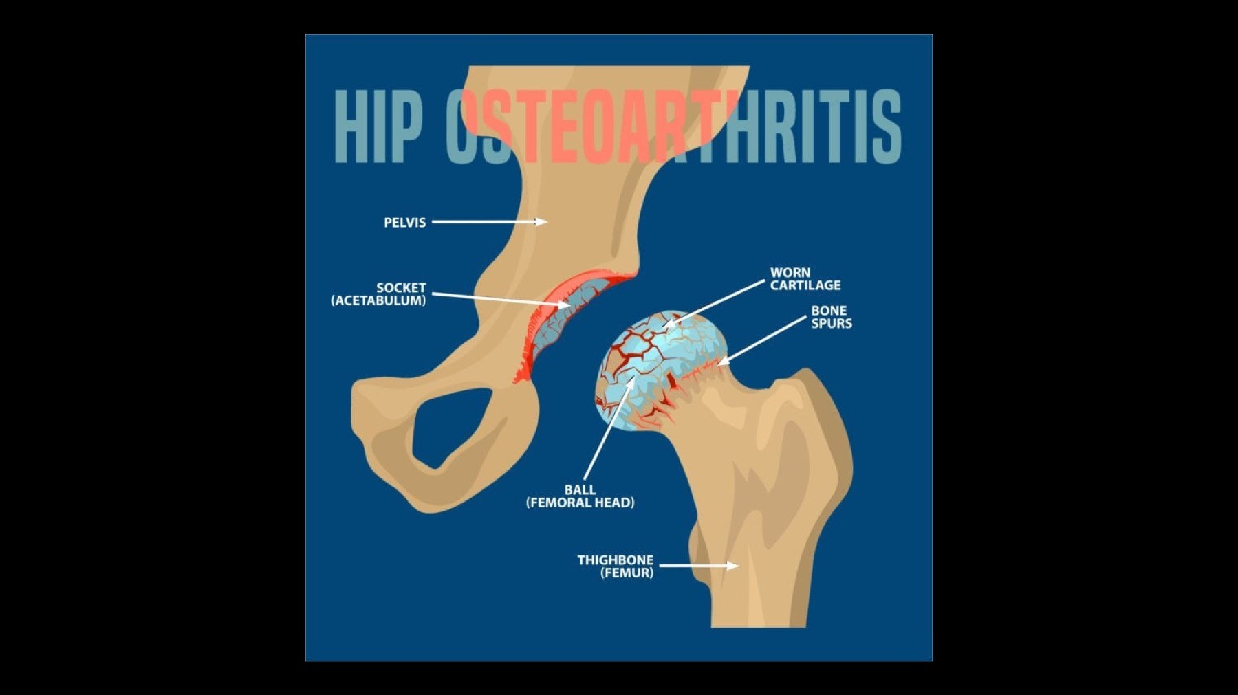 Hip Osteoarthritis and Hip Replacement | Anniston Ortho