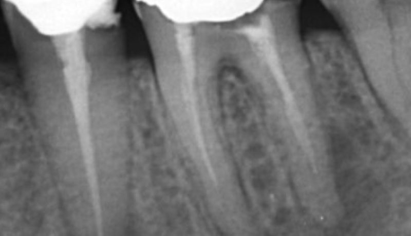 Endodontics | Treatments | The Priestgate Clinic
