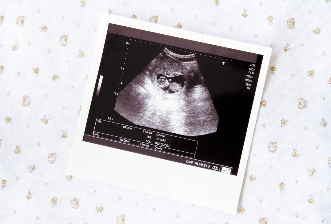 Early Pregnancy: What to expect in your 6 week ultrasound