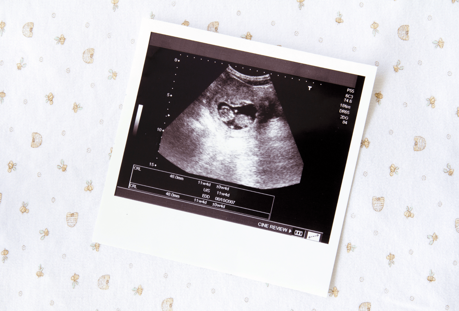 Early Pregnancy: What to expect in your 6 week ultrasound