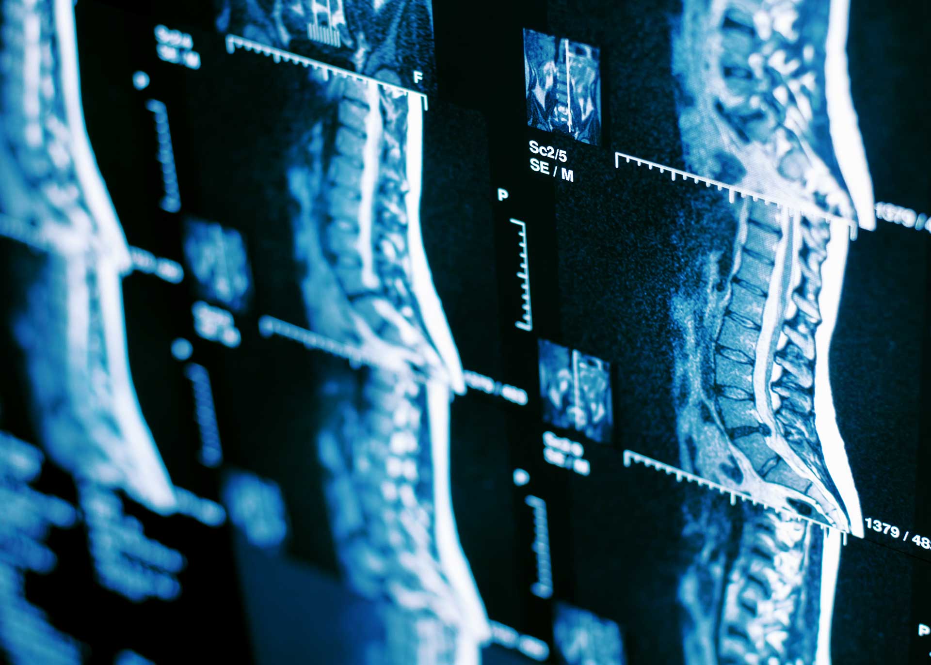 Back Injury - California Attorney Group