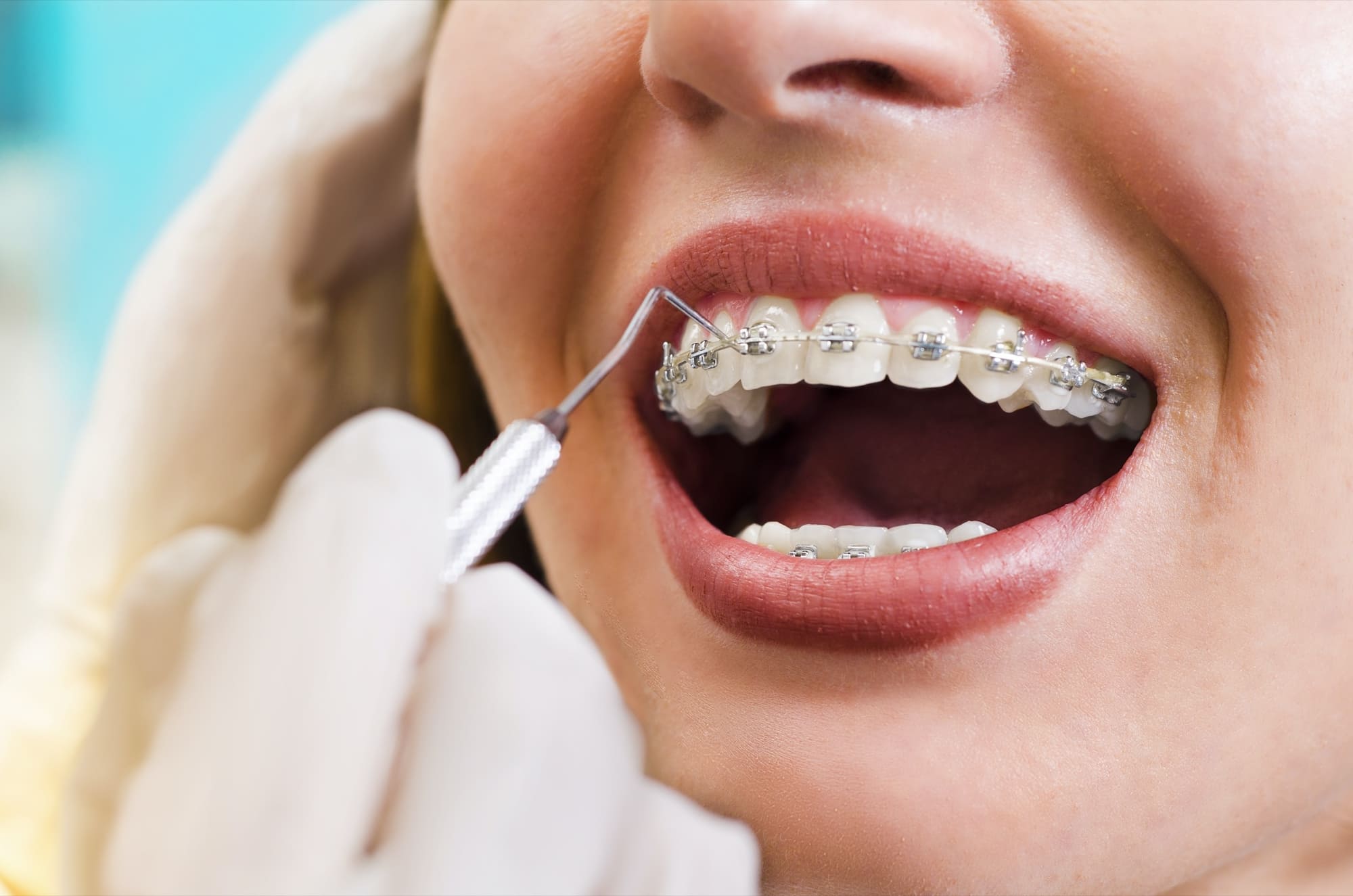 Fixed Braces | The London Orthodontic Group