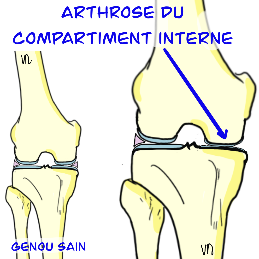 Ostéotomie autour du genou - Professeur Etienne Cavaignac - Chirurgien ...