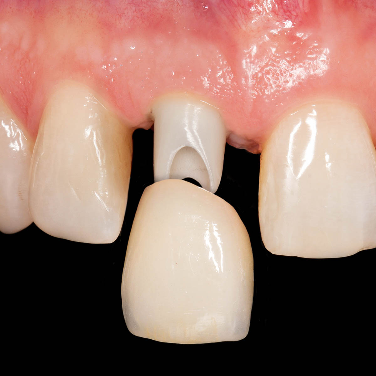 Dental Crowns | United Dental Care | Private & NHS Patients