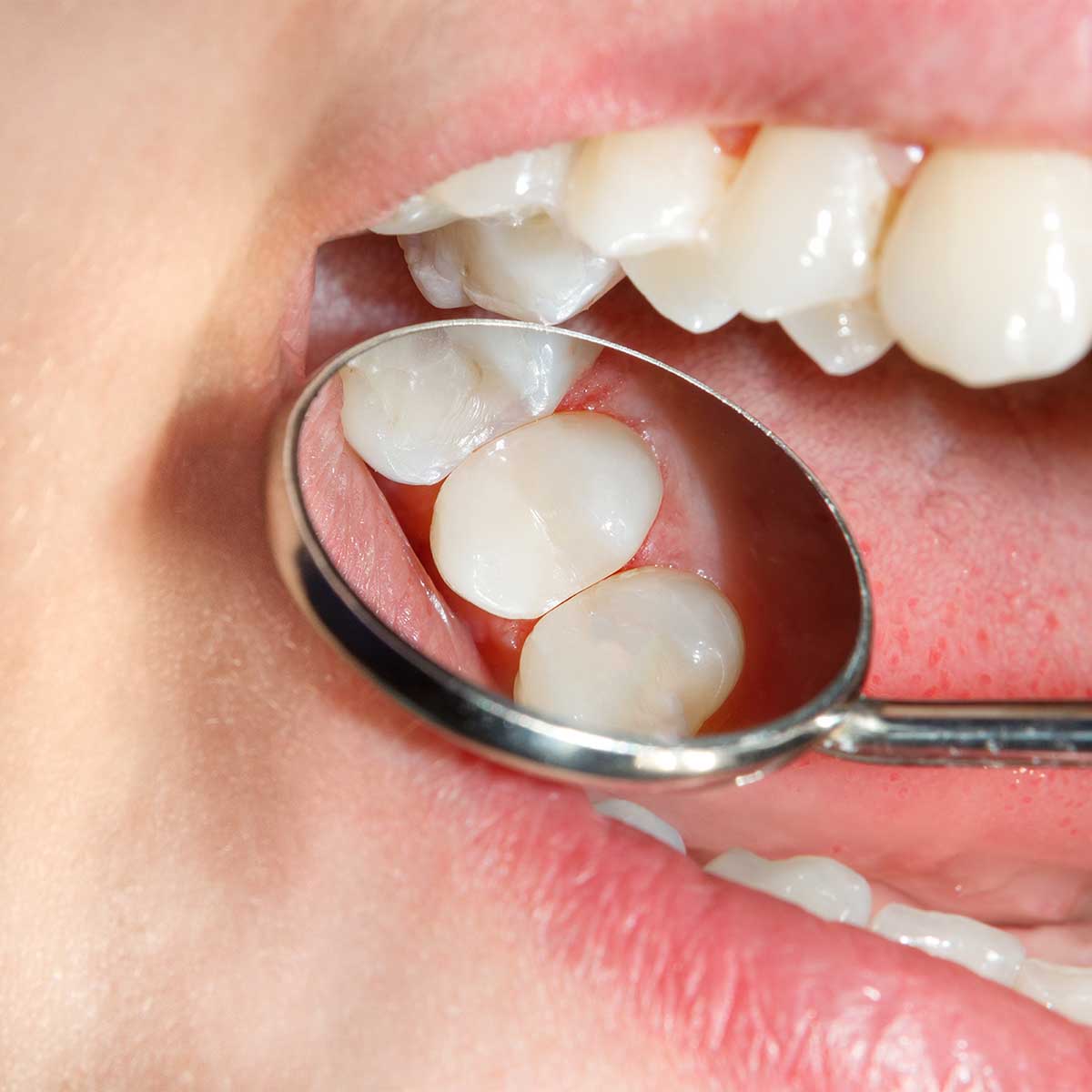 Tooth Coloured Fillings | United Dental Care | Private & NHS Patients