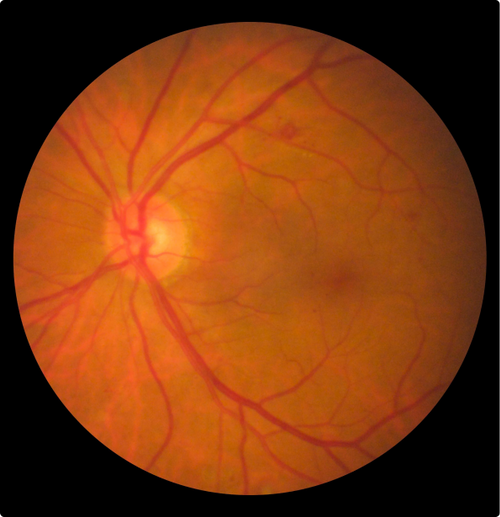 Remidio FOP NM-10 | Non Mydriatic Hand Held Fundus Camera