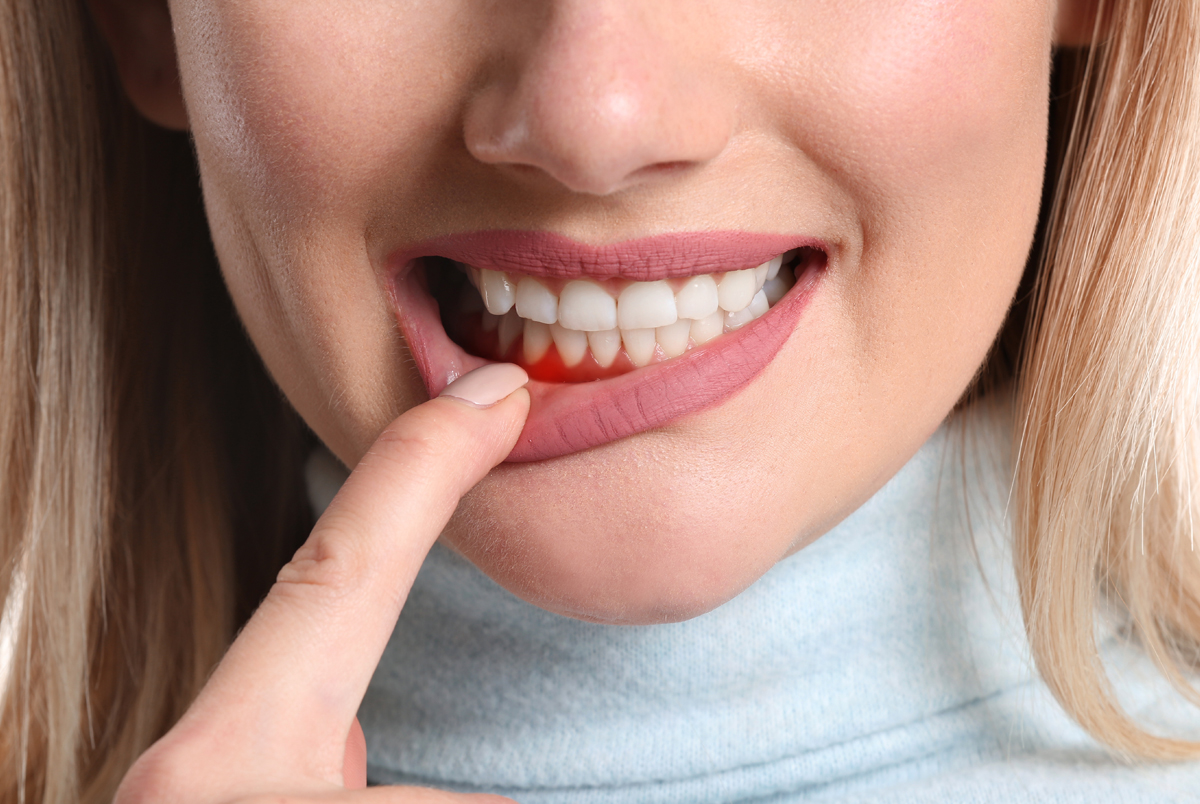 Periodontal Disease: What is It and How is It Treated?