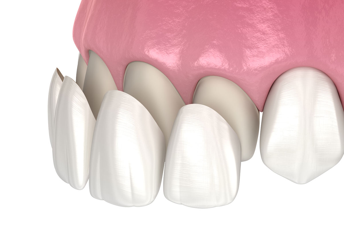 Is Tooth Bonding Your Answer for the New Year?