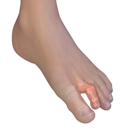Learn More About Bunions | What Are Bunions