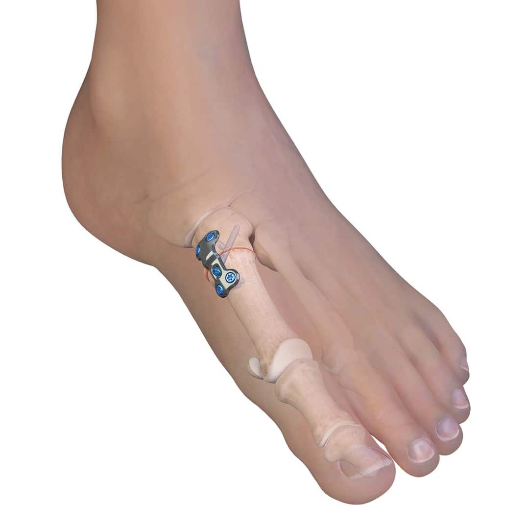 Learn More About Bunions | What Are Bunions?