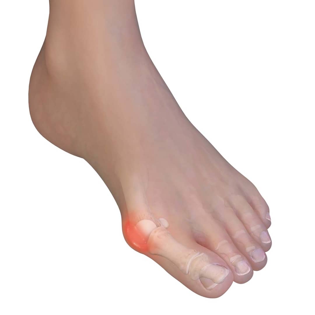 Learn More About Bunions | What Are Bunions?