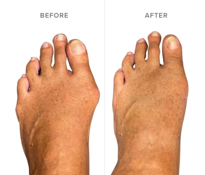 Bunion Correction Surgery | Arthrex Bunionectomy