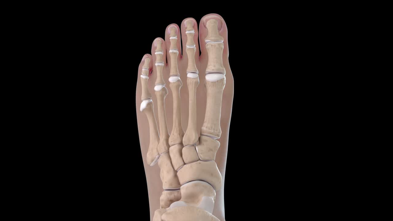 Minimally Invasive Bunion Surgery | Arthrex Bunionectomy