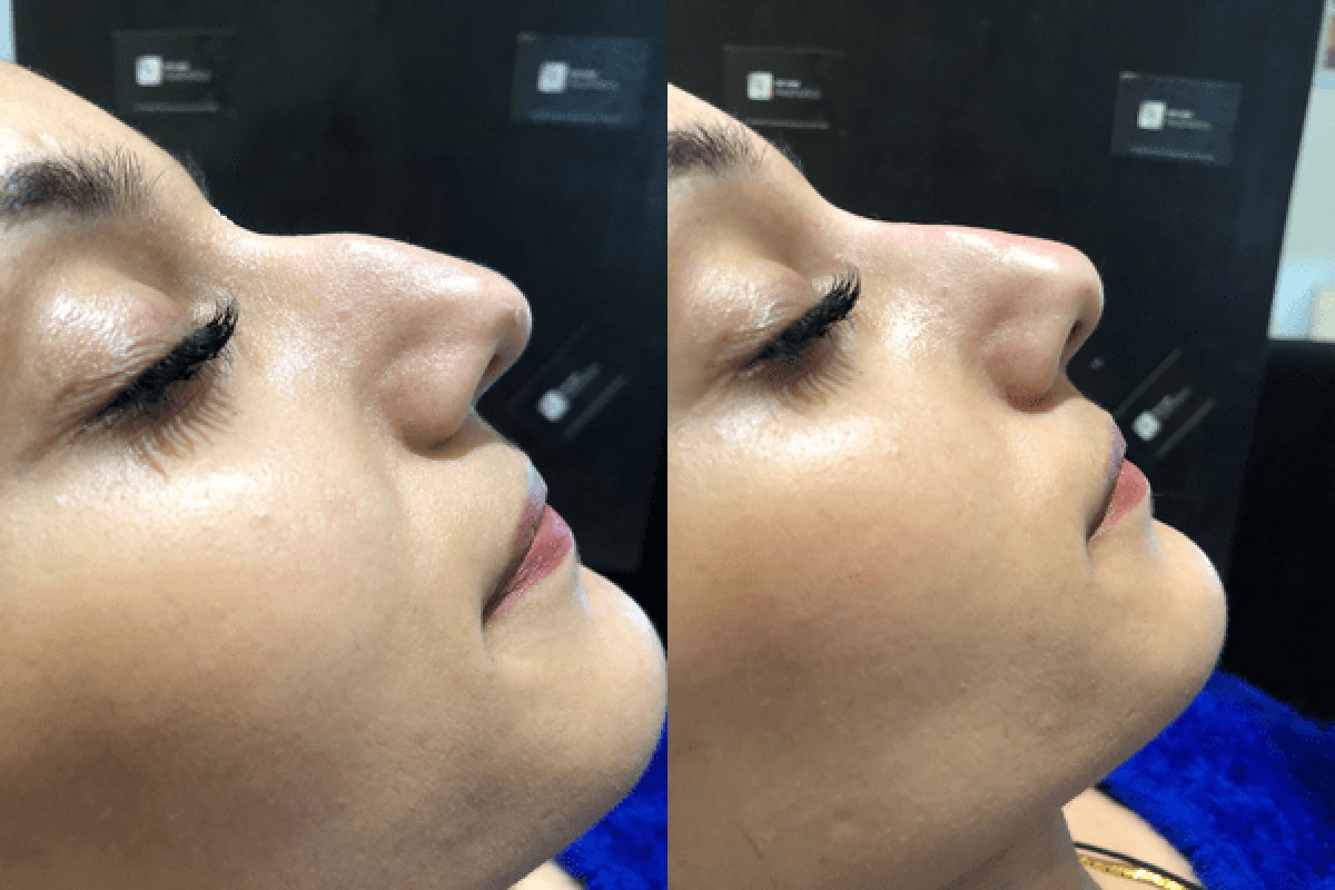 Non Surgical Nose Job | Non Surgical Rhinoplasty – Dr Ash Labib