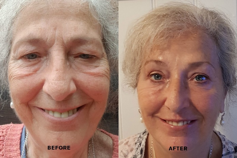 8 Point Facelift | Non Surgical Face Lift Cost – AL Aesthetics