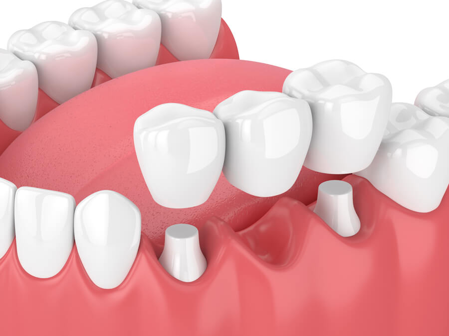 Bridges Issaquah | Apex Dental Care