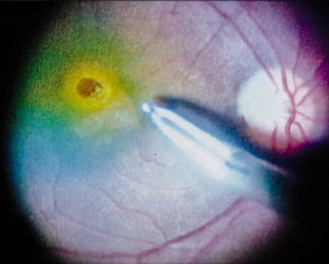 ICG Staining and Chromovitrectomy - Milestones In Retina