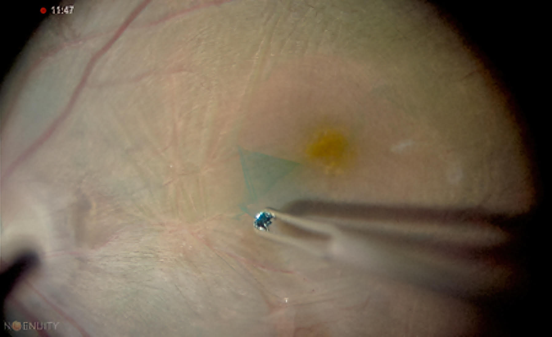 ICG Staining and Chromovitrectomy - Milestones In Retina