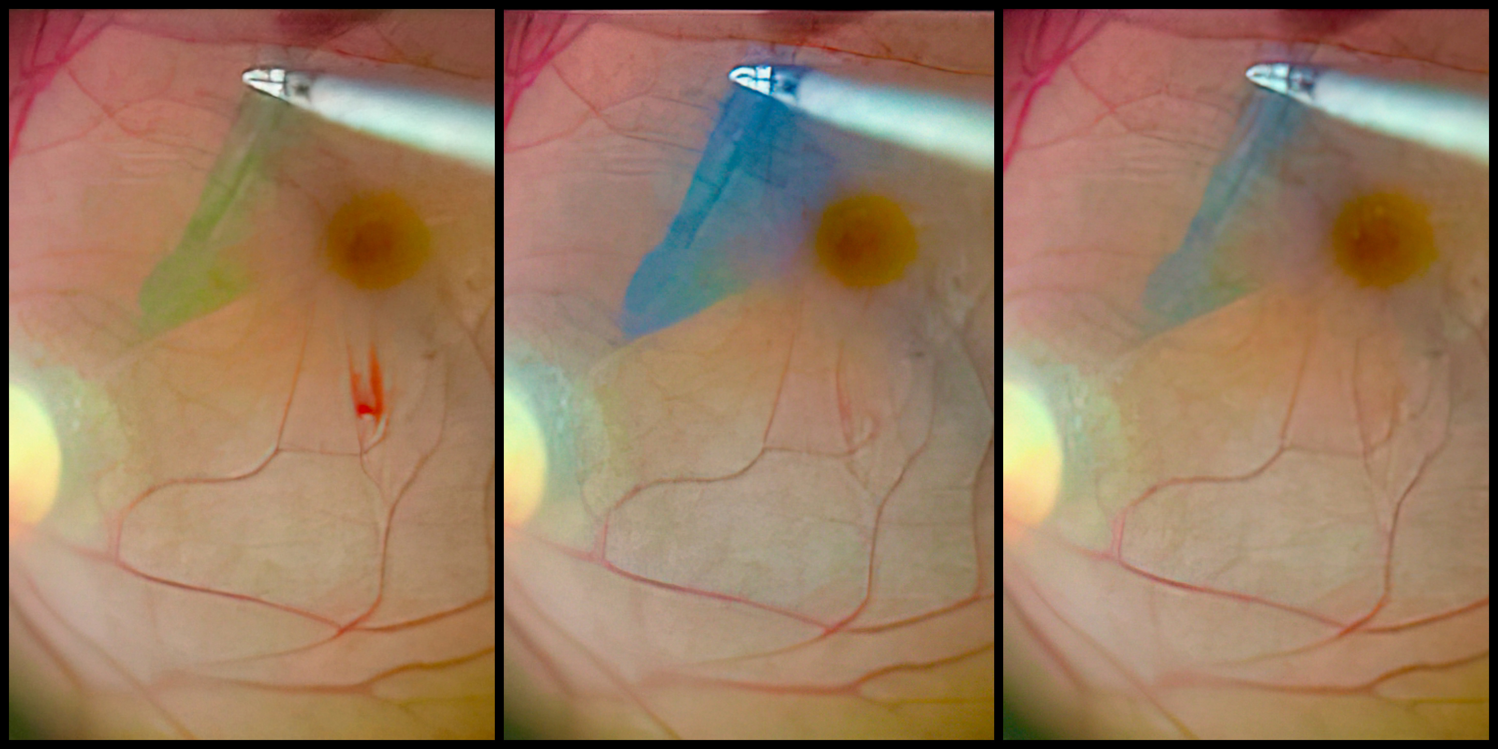 ICG Staining and Chromovitrectomy - Milestones In Retina
