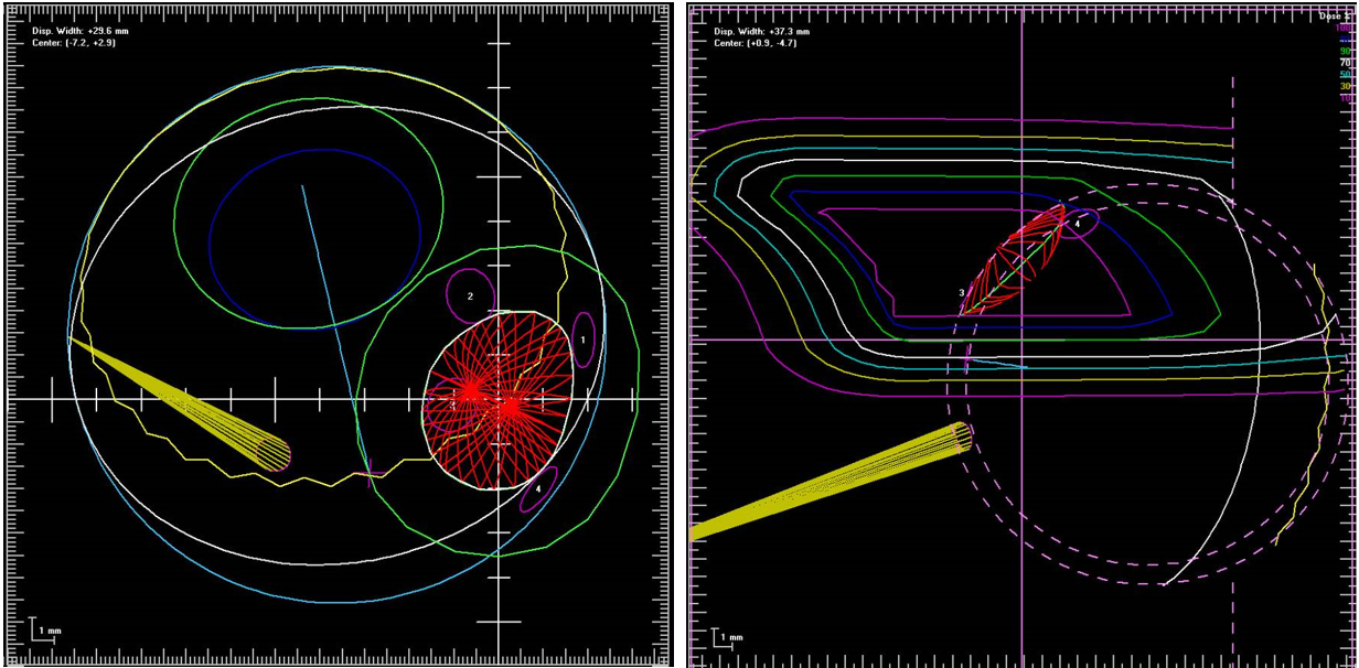 History of Proton Beam Irradiation - Milestones In Retina