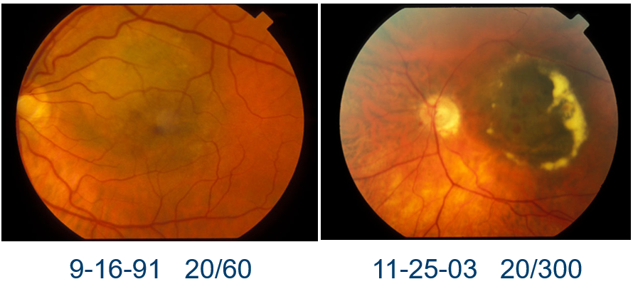 History of Proton Beam Irradiation - Milestones In Retina