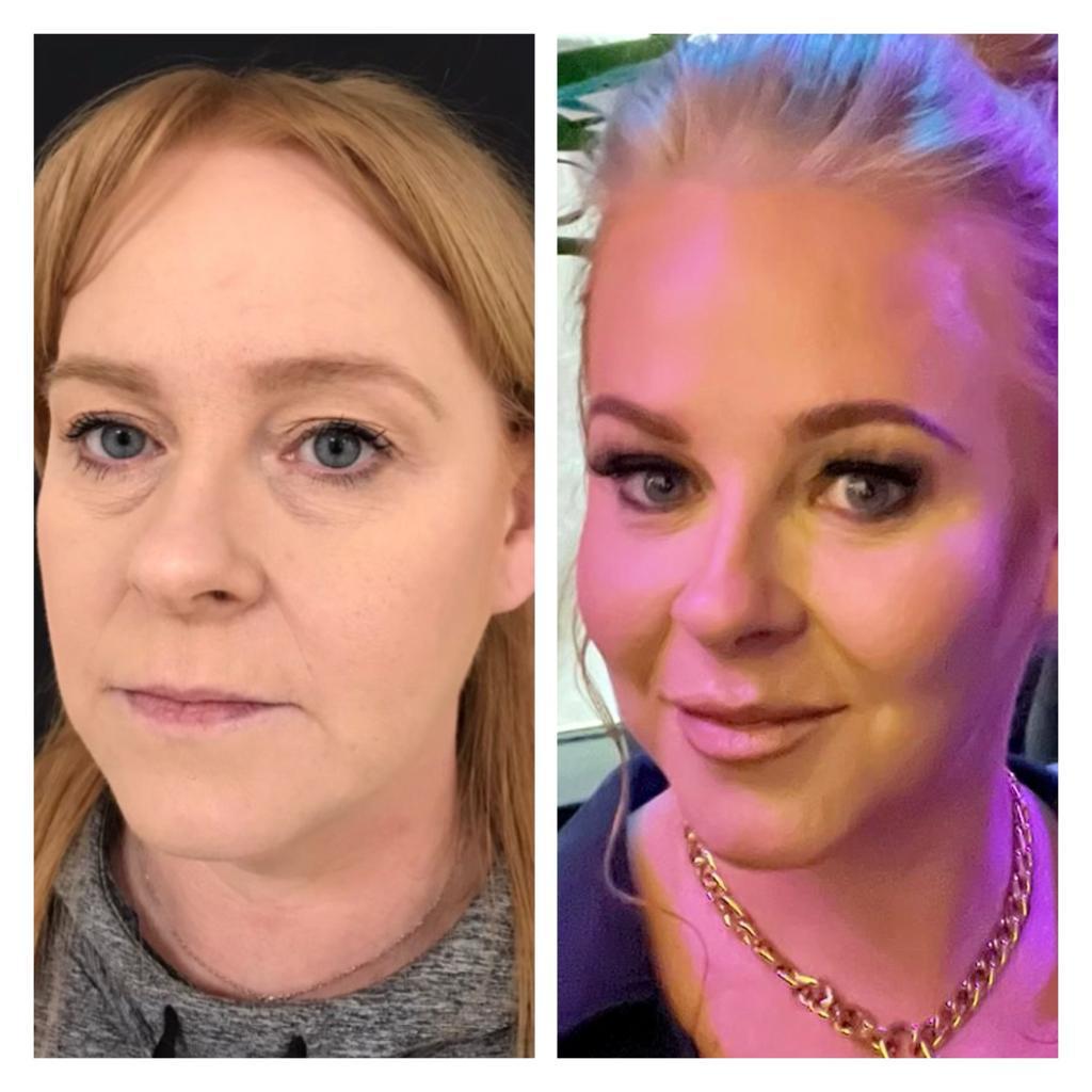 Loss of volume | Alisha Louise Aesthetics | Skelmersdale