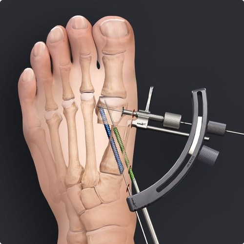 Arthrex Bunionectomy | Minimally Invasive Bunion Correction