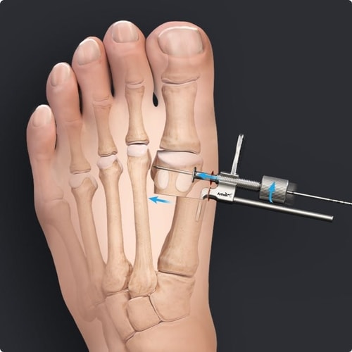 Arthrex Bunionectomy | Minimally Invasive Bunion Correction