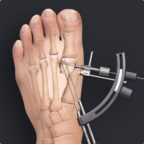 Arthrex Bunionectomy | Minimally Invasive Bunion Correction