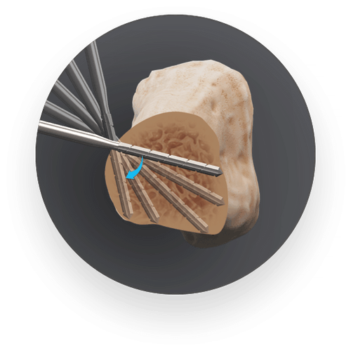 Arthrex Bunionectomy | Minimally Invasive Bunion Correction