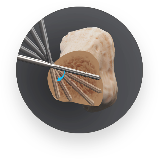 Arthrex Bunionectomy | Minimally Invasive Bunion Correction