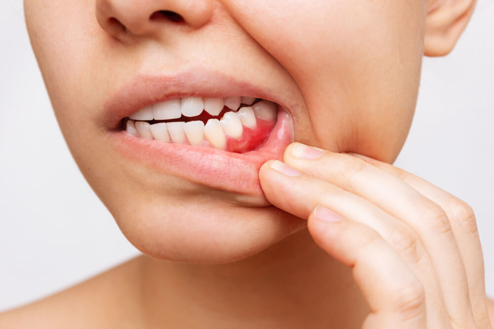Can You Reverse Gum Disease? | Fremont Family Dentistry