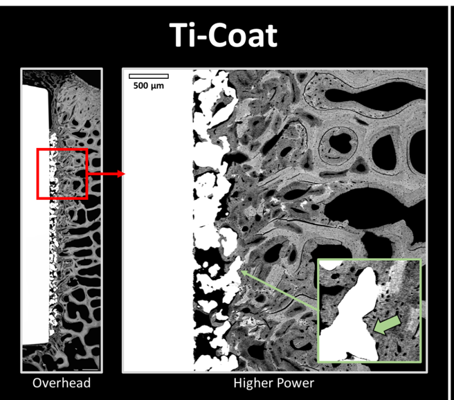 Klassic® Hip System | TJO - Total Joint Orthopedics