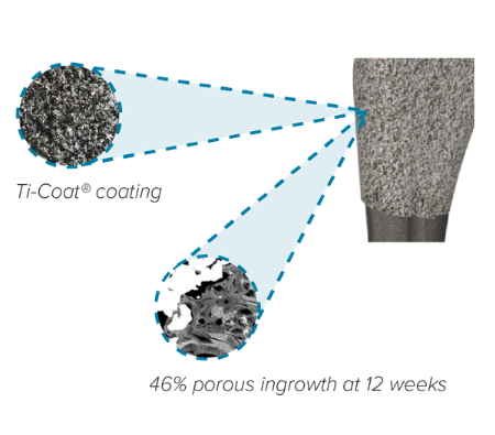 Klassic® Hip System - FRACTURE