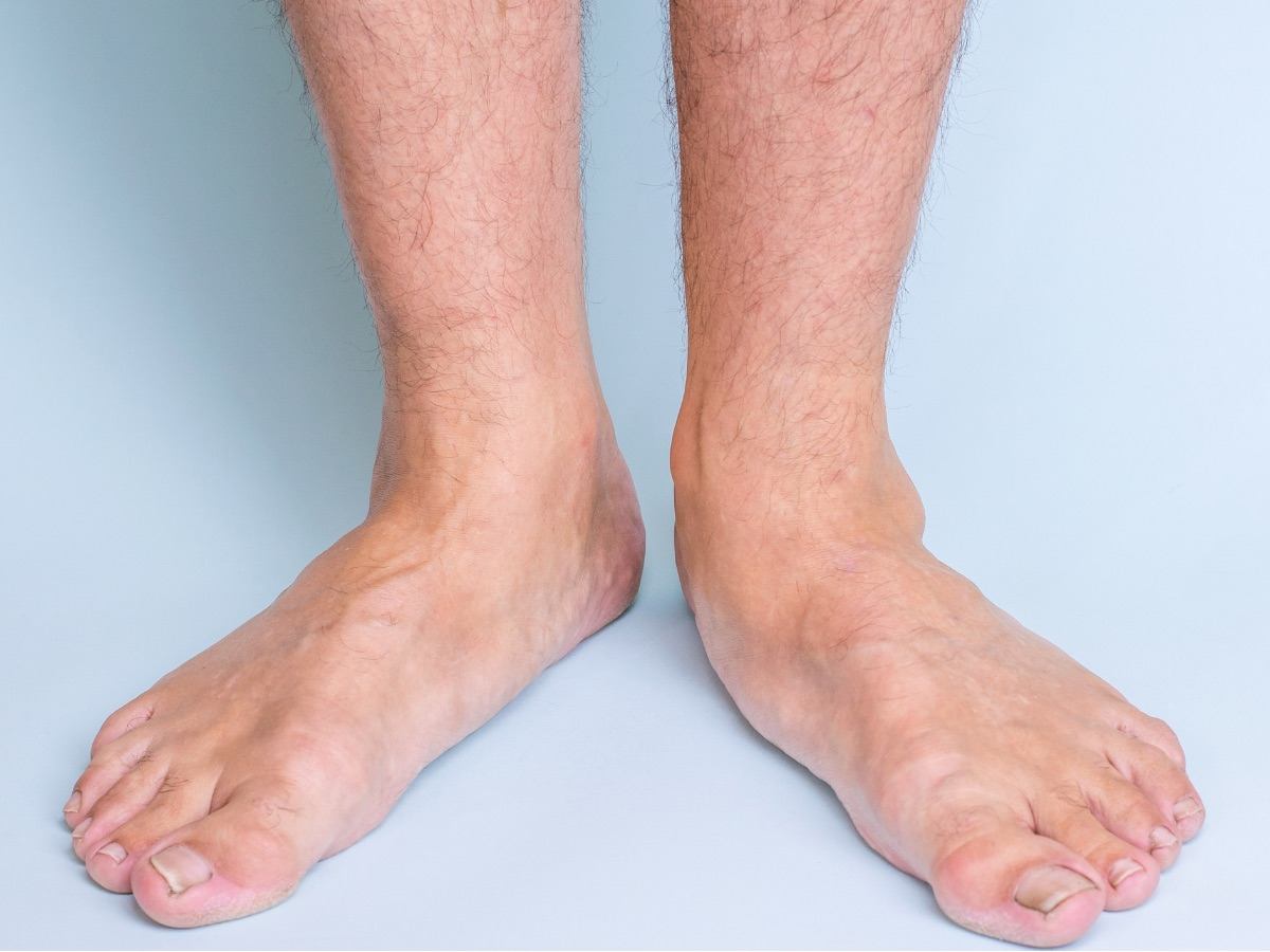 What’s the deal with flat feet? - Blog | Dan Everson Podiatry