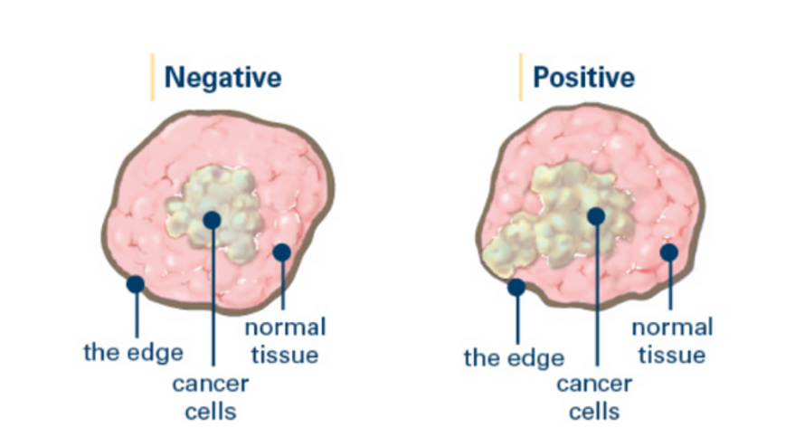 Guide To Understanding Surgical Margins KUBTEC