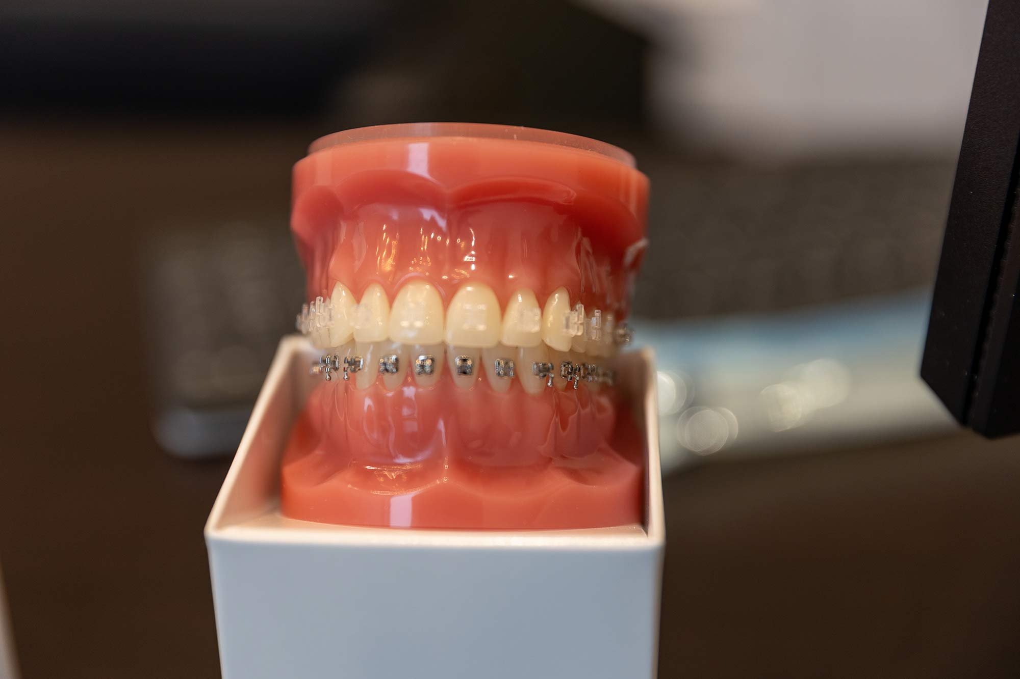 Life with Braces: Things you need to know about braces